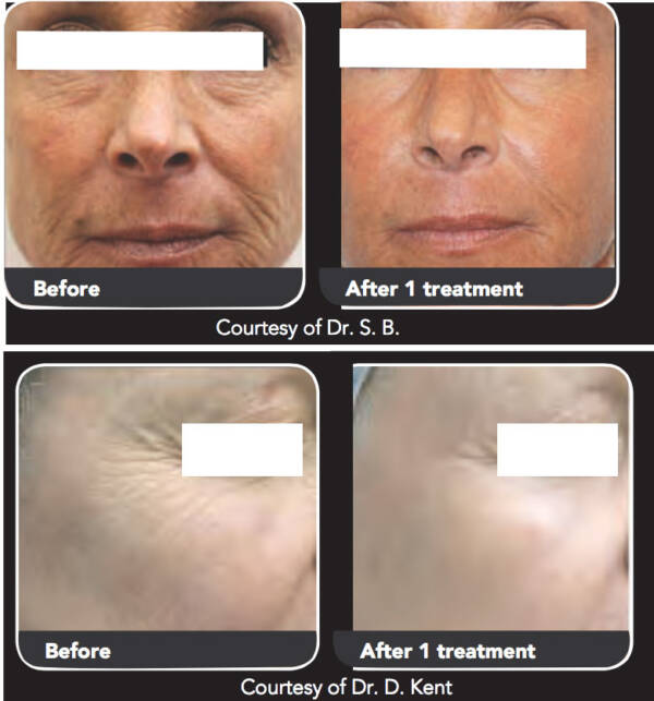 CoolPeel Tetra CO2 Skin Rejuvenation Benefits